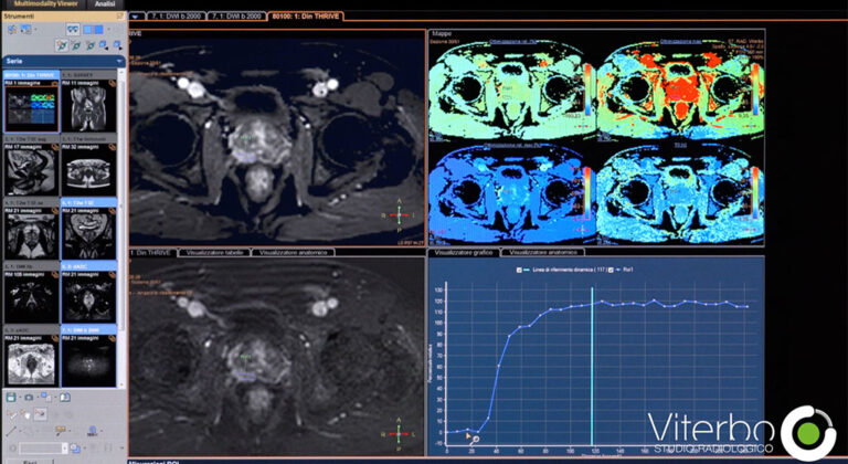 Risonanza Magnetica Multiparametrica prostata - Studio Viterbo